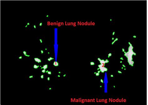 Malignant And Benign Lung Nodule [16] Download Scientific Diagram