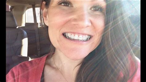 Treehouselane Adult Braces