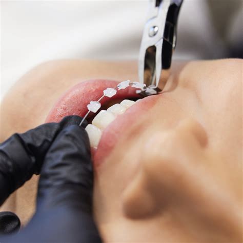 Symetri Clear Advanced Clear Bracket With Refined Strength