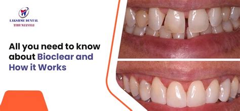 How To Remove Stains From Teeth Instantly