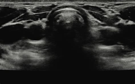 Ectopic Thyroid Endocrinesurgerynetau