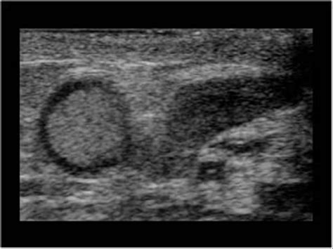 Breast And Axilla 5 1 Benign Lesions Case 5 1 10 Ductal Lesions Ultrasound Cases