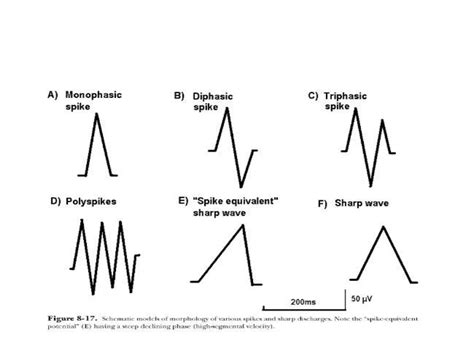 Recognition Of Abnormal Eeg Pptx