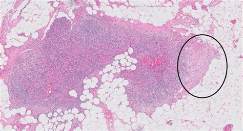 Hematoxylin And Eosin Stain Lymph Node Tissue With Thyroid Inclusions