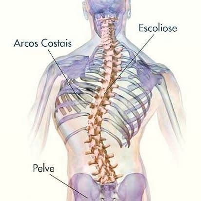 Essa deformidade da coluna vertebral é conhecida como escoliose e pode se manifestar desde a ...