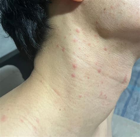 갑자기 목에 붉은반점이 생기는 이유 지식in