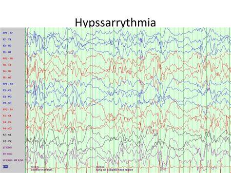 Abnormal Eeg Patterns Ppt