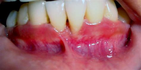 Labial Frenectomy Before And After