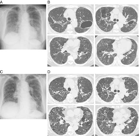 Honeycomb Chest X Ray Bronchiectasis At Mandy Robinson Blog