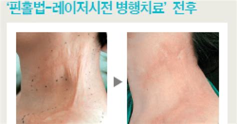 병원 리포트 울퉁불퉁 화상 흉터 레이저 치료 길 열려