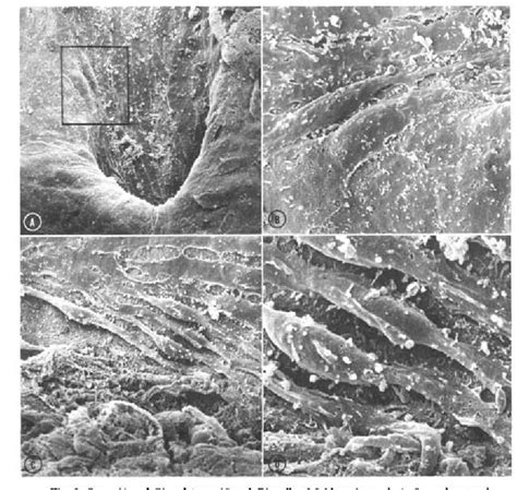 Figure 8 From Scanning Electron Microscopy Of The Trabecular Meshwork In Normal And Glucomatous
