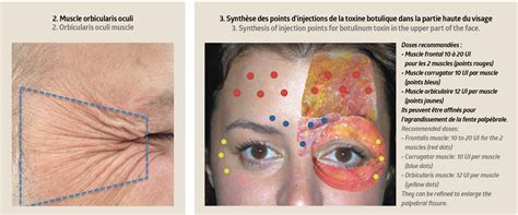 Frontalis Muscle Botox