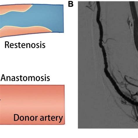 Different Stages Of Outflow Vein Remodeling Download Scientific Diagram