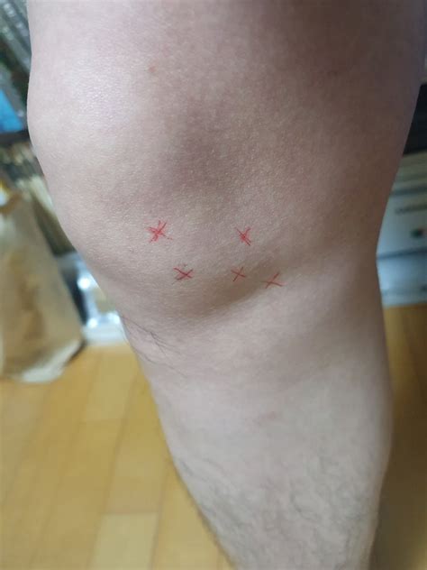 무릎 통증부위 표시해봤는데 연골문제일까요 지식in