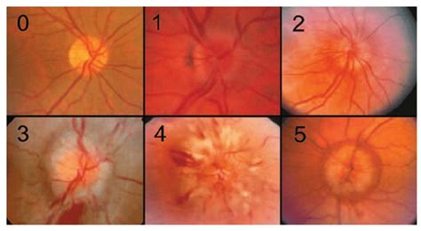 Classification Of The Degree Of Papilledema According To The Modified