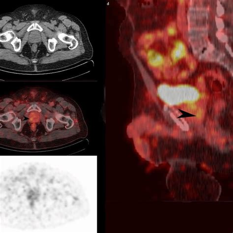 A 80 Year Old Patient Status Post Radical Prostatectomy Psa Level At Download Scientific