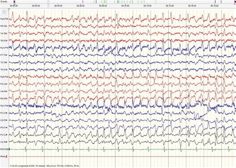 A Treatable Encephalopathy In A Peritoneal Dialysis Patient Cefepime