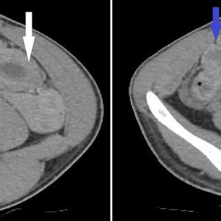 Intraoperative Laparoscopic View Showing Ileocecocolic Intussusception Download Scientific Diagram