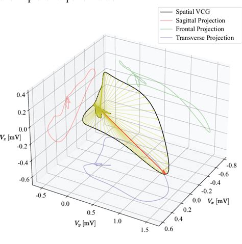 Figure 1 From Vectorcardiographic Reconstruction From Standard 12 Lead Electrocardiogram Using