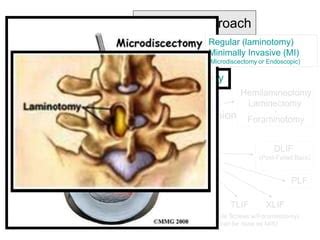 Laminectomy Vs Discectomy In Rehabilitation Ppt