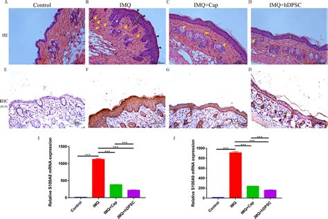 Effect Of Hdpsc On Abnormal Epidermal Proliferation Of Imq Induced