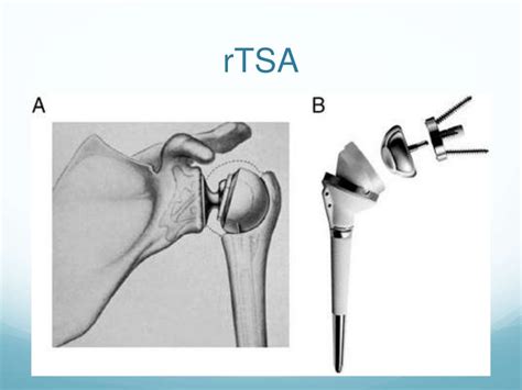 Total Shoulder Arthroplasty And Reverse Tsa Hussain Algawahmed