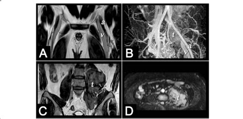 Multiplanar Mri Was Helpful For Comprehensive Diagnosis Our Mri