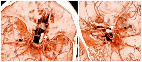 Craniopharyngioma Resection And Aneurysm Clipping Performed