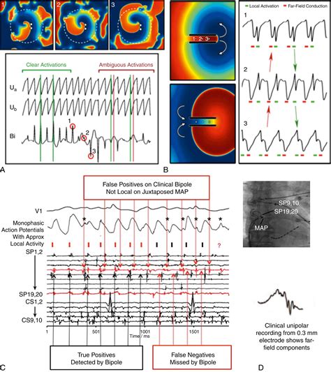 Rotational And Focal Sources Of Atrial Fibrillation Scientific Rationale And Comparative