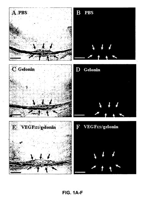 Vascular Targeting Of Ocular Neovascularization Eureka Patsnap