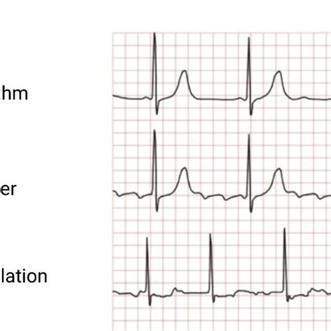 Understanding Arrhythmias Identifying Shockable Rhythms
