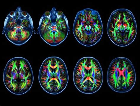 Diffusion Tensor Imaging Diffusion Tractography