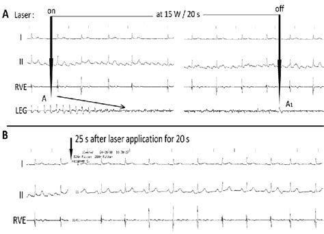 Bipolar Focused Local Electrogram Leg Recorded During Redo Laser