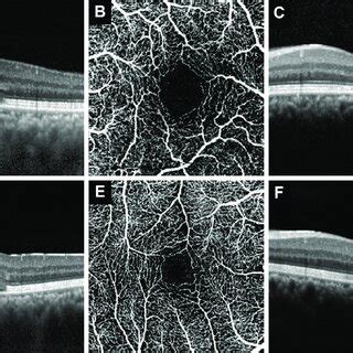 Horizontal Section Of OCT Image And OCTA Image Of SCP Of A 67 Year Old Download Scientific