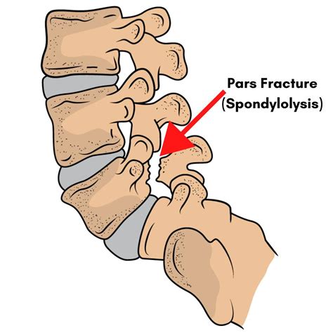 Orthorelieve 📢 What Is Pars Defect Spondylolysis