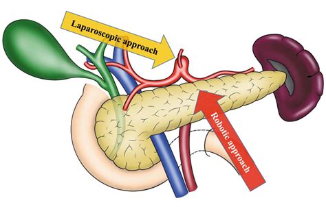 Splenic Artery