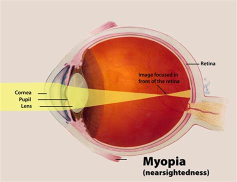 Diagram Diagram Of Eye With Myopia Mydiagramonline