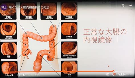 大腸がん検診内視鏡検査 大腸がん検診 内視鏡 費用 Nvrcq