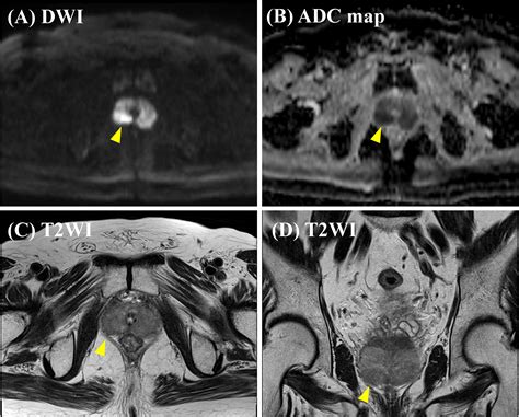 Cryptococcal Prostatitis In An Immunocompromised Patient With