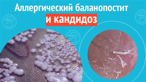 💣 Аллергический баланопостит и кандидоз Клинический случай №1106 Youtube
