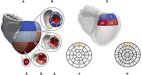 Patient Specific Lv Segment Models Generic Aha 17 Segment Model Is
