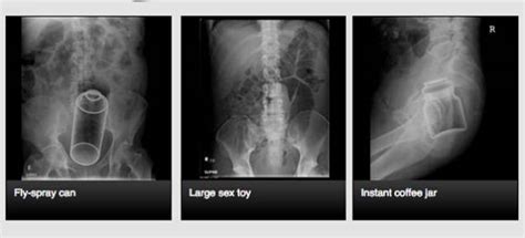 This Website Radiopaedia Lets You See X Rays Of All The Weird Things