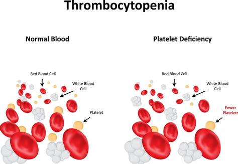 Thrombocytopenia Causes Symptoms And Treatment Options
