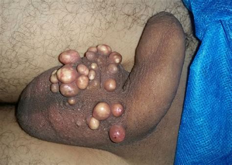 Presence Of Multiple Calcified Nodules In The Anterior Region Of The