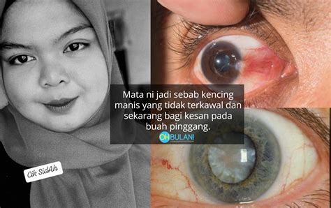 Diabetes Beri Kesan Kepada Mata My XXX Hot Girl