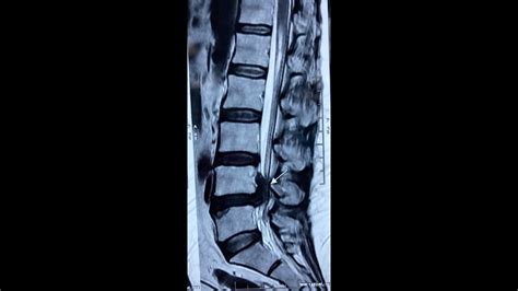 Endoscopic Discectomy L4 L5 At Eula Seay Blog