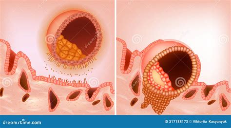 The Process During The Embryo Implantation The Blastocyst Implants To