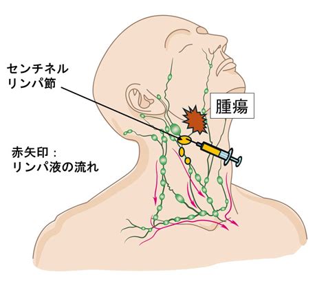 リンパ節転移の診断と治療 研究室公開 電気情報物理工学科 オープンキャンパスネット