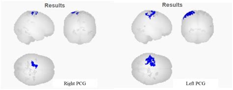 Effects Of Intermittent Theta Burst Stimulation Over Primary Motor Cortex On Functional