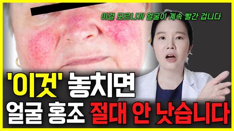 안면홍조 없애는 방법 ㅇㅇㅇ 알아야 완치할 수 있습니다 얼굴 붉음증 원인 치료 Youtube